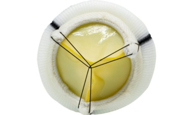 Meril – Dafodil Pericardial Bioprosthesis - Asil Tıbbi Sistemler